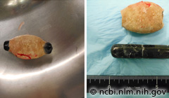 Foreign body in the bladder: A case report - Case Reports - Gynecology ...