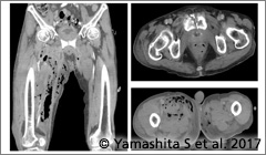 Necrotizing fasciitis after high-dose rate brachytherapy and external ...