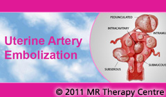 Serial Uterine Artery Embolization for the Treatment of Placenta ...