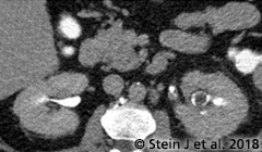 Fungaemia caused by obstructive renal candida bezoars leads to ...