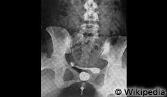 Cornual uterine diverticulum following a failed pregnancy - Case ...