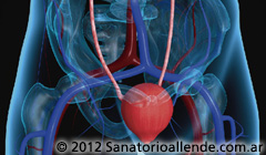 Bladder Neck Contracture after Transurethral Resection of the Prostate ...